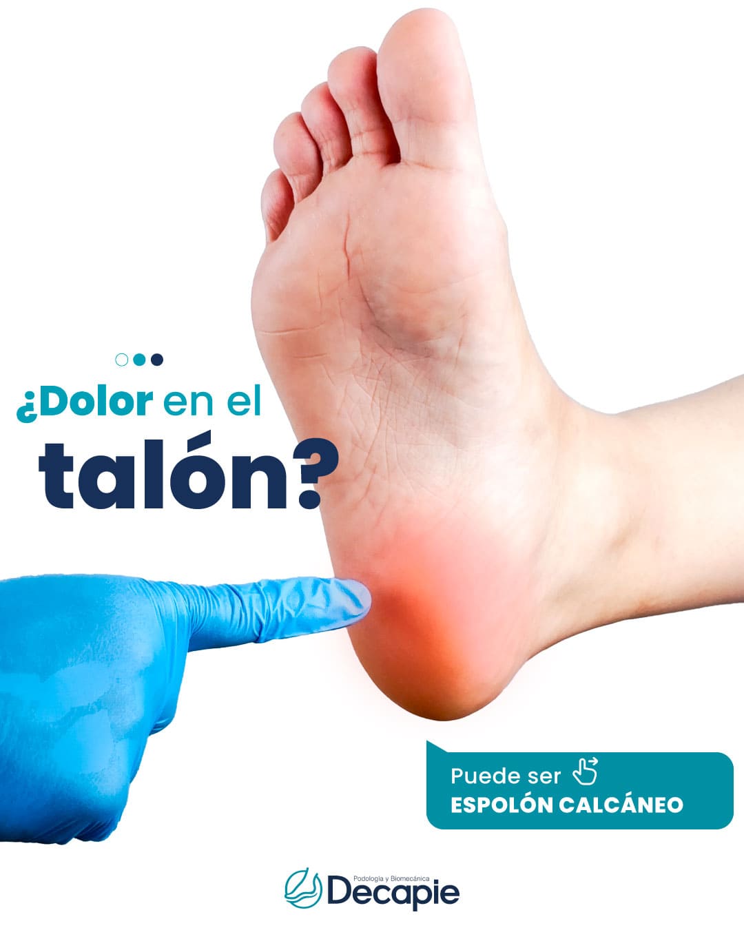 Espolón calcáneo: Qué es, síntomas y tratamientos efectivos - Decapie